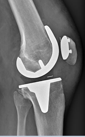 Traumatologie du genou Royan - Cabinet orthopédique à Royan