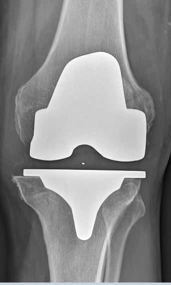 Traumatologie du genou Royan - Cabinet orthopédique à Royan